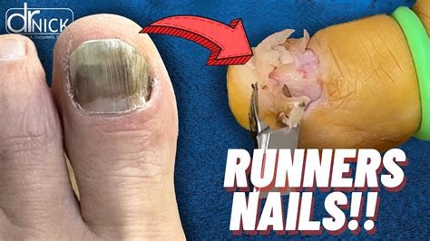 Runners Toenail Problems