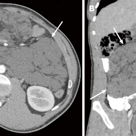 Computed Tomography Image Of Confluent Peritoneal Cystic Lesions A
