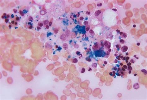 The 6 Most Common Bone Marrow Diseases Its Psychology