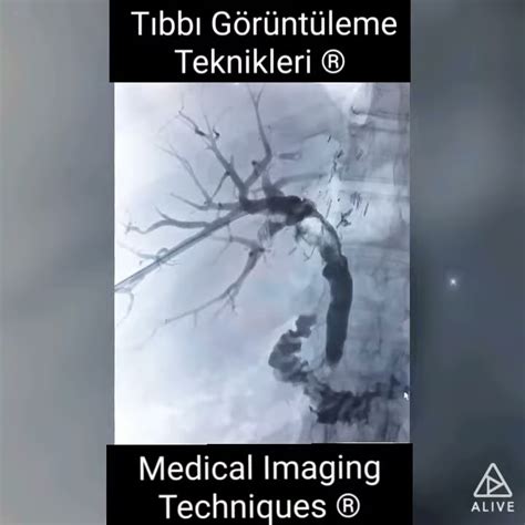 Perkütan Transhepatik Kolanjiografi Percutaneous Transhepatic