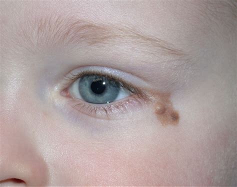 Eyelid Lesions Gp Eyes