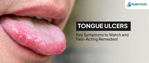 Canker Sore Tongue