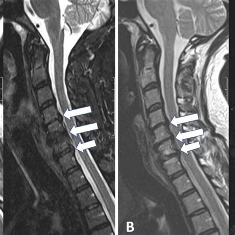 Hyperintensity On T2w Of Annular Fissures At Initial And Follow Up