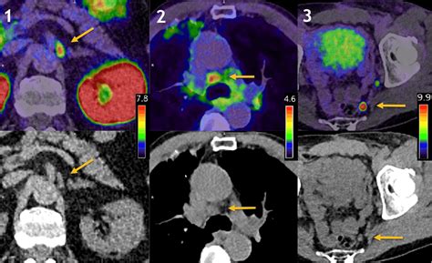 Example Images Showing A Benign Ganglion With Intensive Psma Uptake 1 Download Scientific