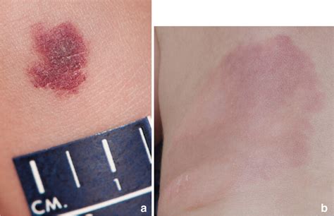 Capillary Malformations A Clinical Image From A 10 Year Old Girl Shows Download Scientific