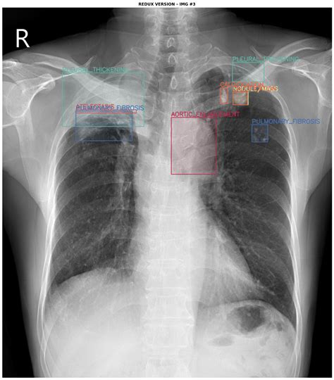 GitHub InDSweTrust VinBigData Chest Xray Abnormalities Detection