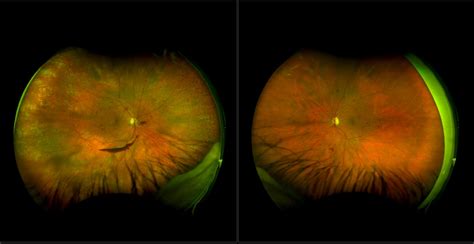 California Diabetic Retinopathy With Prp Rg