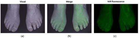 Icg Nir Fluorescence Imaging In A Control Patient Showing The Visual