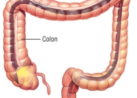 Negative Colonoscopy Screening Linked To Reduced Risk Of Colorectal