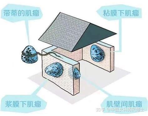长在这几个位置的子宫肌瘤，不管多小都要赶紧调理！ 知乎