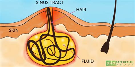 Pilonidal Disease Safe Health Group Ltd