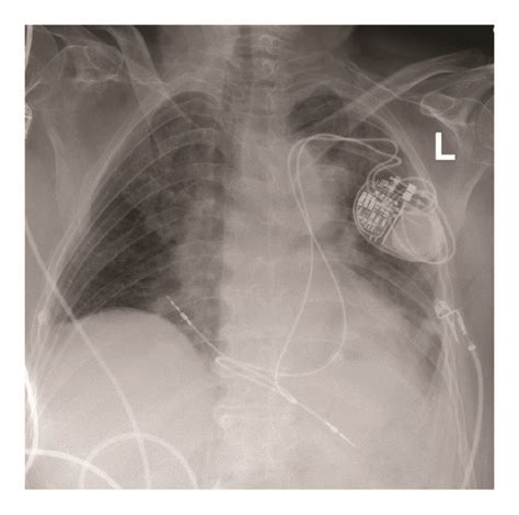 A Chest X Ray Immediately Following Pacemaker Inserti
