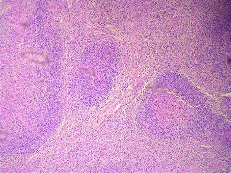 Lymph Node Section Showing Follicles With Prominent Germinal Centre And