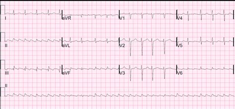 Icd 10 Code For Atrial Flutter Recnibht
