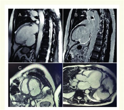 Cardiac Magnetic Resonance Images A Two Chamber Steady State Free