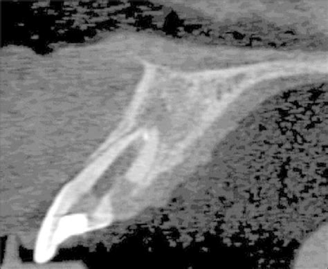 Cbct Sagittal Section Showing The Extent And Location Of The Resorption