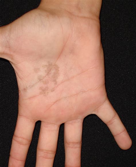 Tinea Nigra Uk
