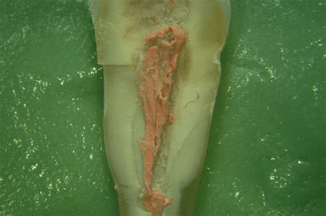 The Canal Obturation Detached From The Walls Of The Root Canal Of The Download Scientific