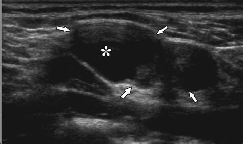 Needle Aspiration Of Thyroid Nodule At Richard Montejano Blog