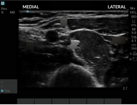 Axillary Block Diagram Quizlet
