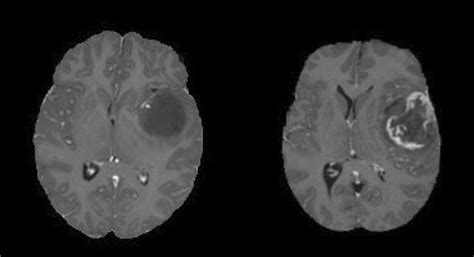 An Example Mri Of Low Grade Glioma Lgg On The Left And High Grade