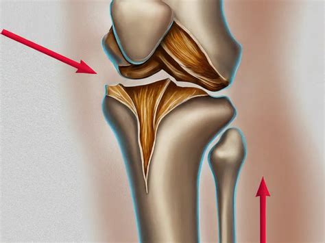 Understanding Tibia Plateau Fracture Causes And Risk Factors Miss