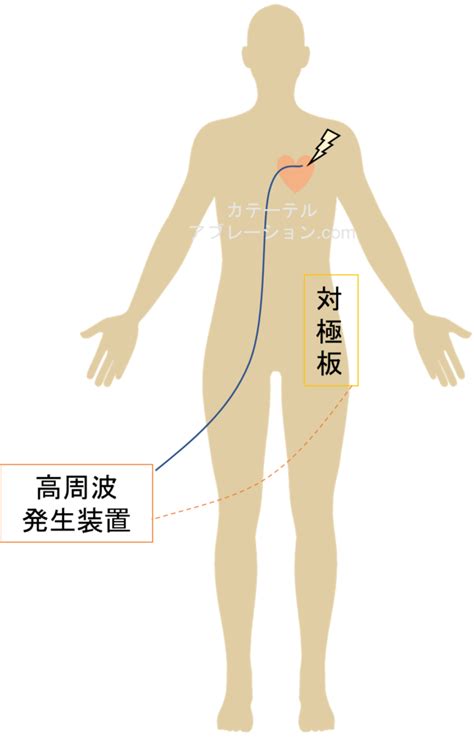 カテーテルアブレーション 心房細動治療com
