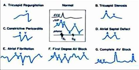 Constrictive Pericarditis Jvp