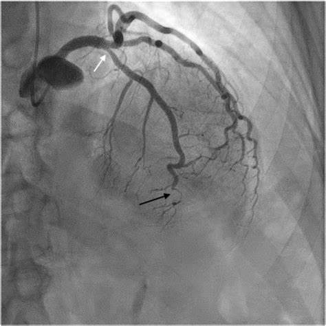 Case Coronary Angiogram Download Scientific Diagram