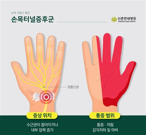 수근관 증후군 증상 8가지 원인 치료법과 손목 통증 운동 스트레칭 정보력