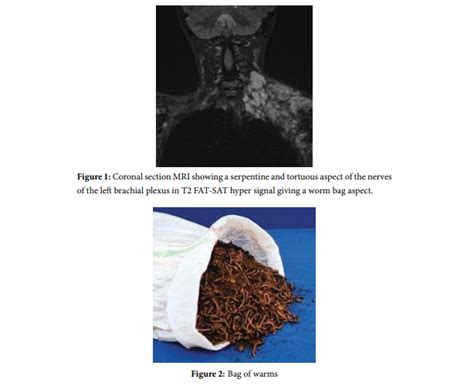 Bag Of Warms Diagnosis In One Eye Of Nodular Plexiform Neurofibroma