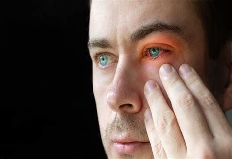Ulcerative Blepharitis Treatment