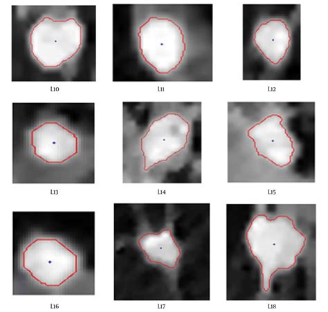 Extracted Malignant Mass Lesions And Their Depicted Contour Using Fuzzy