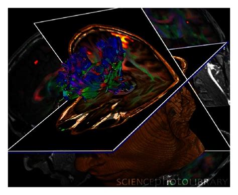 Application Of Nanoparticles On Diagnosis And Therapy In Gliomas Pmc