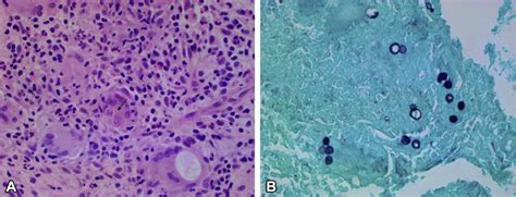 Persistent And Nonprogressive Cutaneous Blastomycosis In A Pregnant Adolescent Abstract