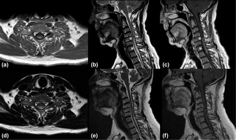 A D Spinal Mri At Clinical Onset B Sagittal T2 Weighted Image