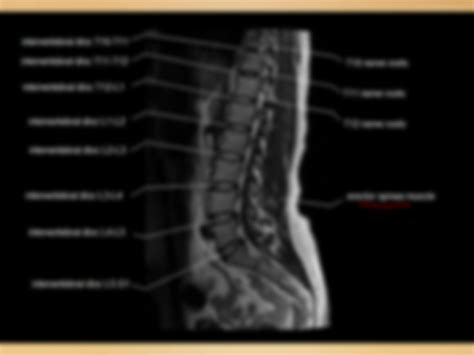 Solution Lumbo Sacral Spine Sagittal Studypool
