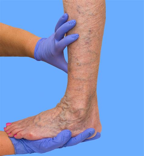 Тромбофлебит нижних конечностей Медицинский центр ФлебоПлюс