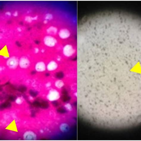 Cryptococcus Was Detected In The Abscess By Microscopic Examination