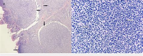 A The Atypical Lymphoid Nodules Were Variable In Size Ranging From