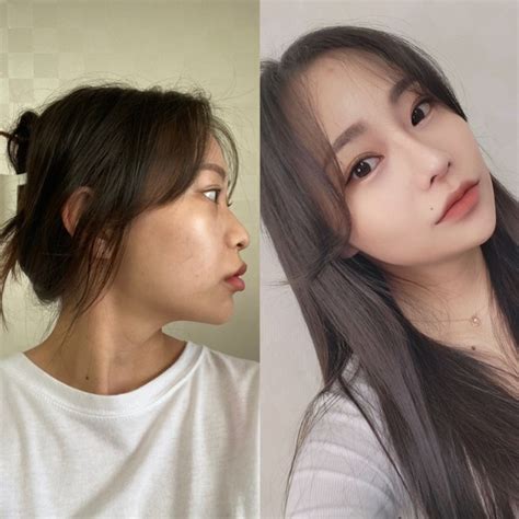 코수술 후기 코수술 6개월차 솔직후기 낮은코 성형후기 코수술 붓기 네이버 블로그