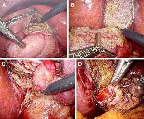 Surgical Procedure In Patients With Severe Cholecystitis A Gallbladder Download Scientific