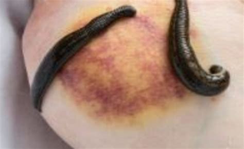 Mastitis Treatment Via Leech Therapy