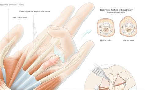 Dupuytrens Fasciectomy On Behance