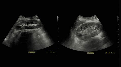 Bladder Ultrasound Procedure Preparation And Results