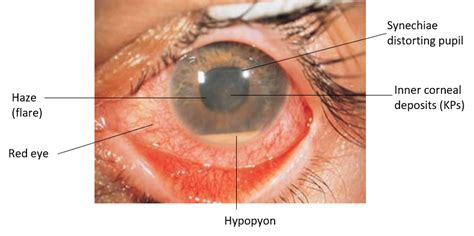 Uveitis 5 Important Points Of Understanding