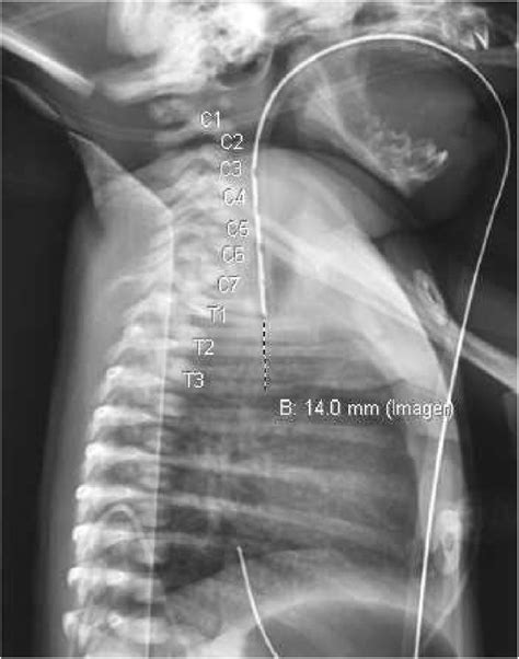 Replogle In The Proximal Esophagus Approximately 1 4 Cm And Two Download Scientific Diagram