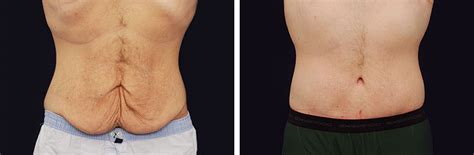 Male Tummy Tuck Scar Tattoo