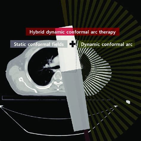 Hybrid Dynamic Conformal Arc Radiotherapy Plan Consisting Of A Single