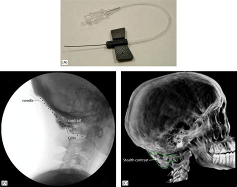 Occipital Nerve Blocks Anesthesia Key
